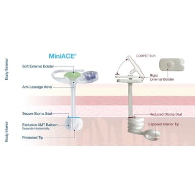 MiniACE Enema Button Device | Enema Device